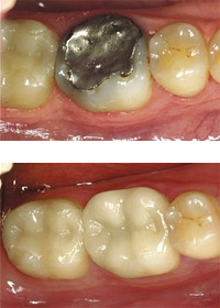 Inlays/Onlays - Dental Services - The Clinic - Dentistry Clinic